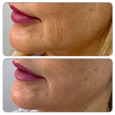 Botox Before and After In Scottsdale Arizona | Botox Photos