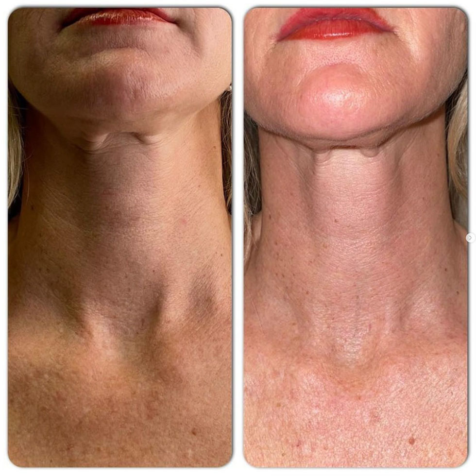 Botox Before and After In Scottsdale Arizona | Botox Photos